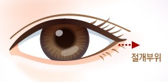 BK Plastic Surgery: Outer corner of eye reshaping