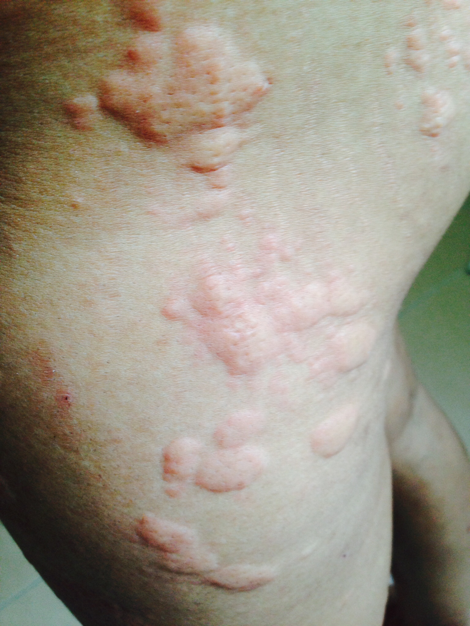 9 Petua Berkesan Hilangkan Gegata Pada Badan Anda