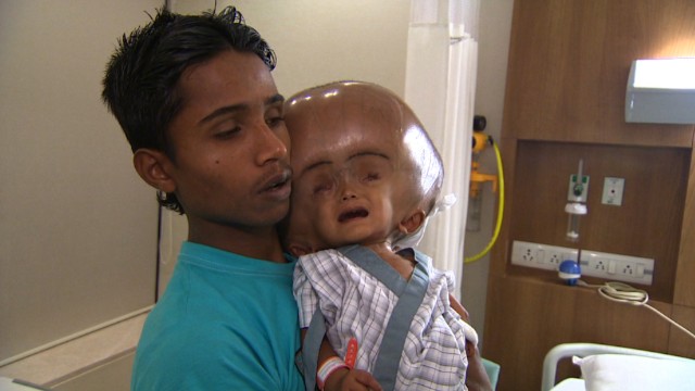 Mixed Scoop: Indian child Roona Begum recovering after hydrocephalus ...