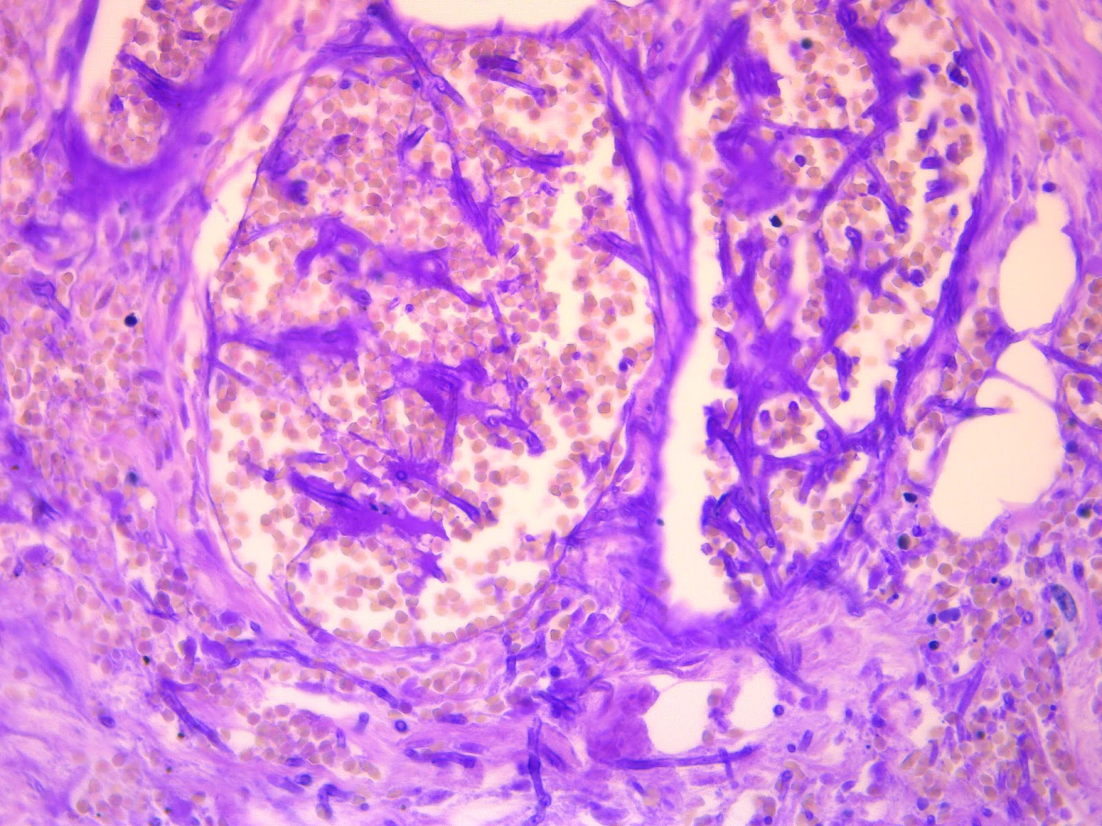 Patología CC: Aspergilosis diseminada / Disseminated aspergillosis