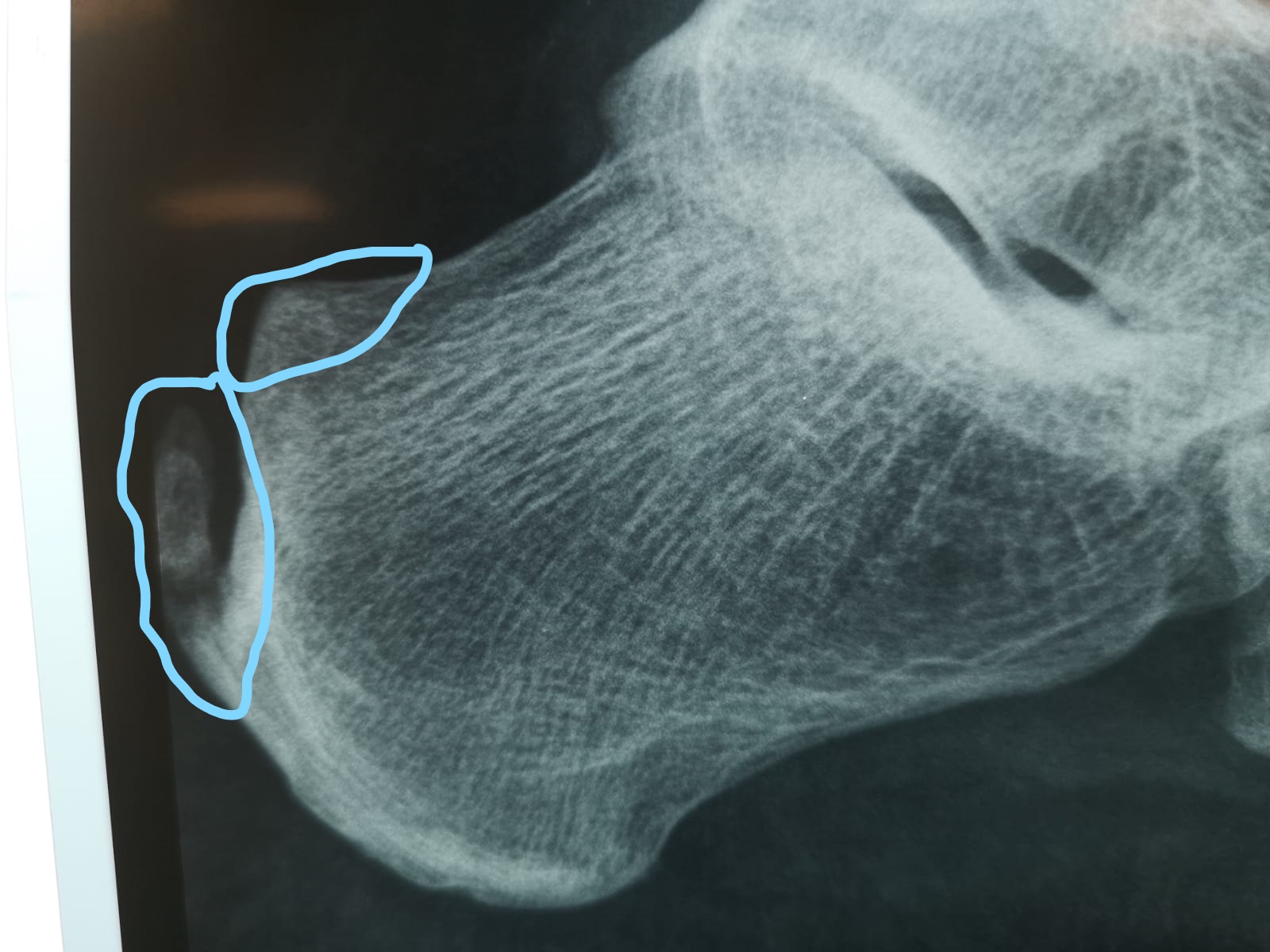 Sportul, si ce face el din calcaiele noastre! Cu sau fara maladia Haglund