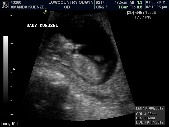 Amy's World: 11 week ultrasound
