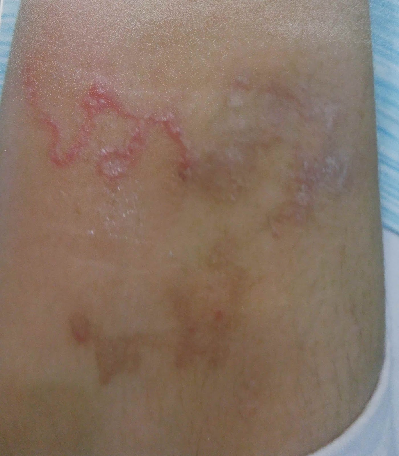 Creeping Eruption (Cutaneous Larva Migrans) : penyakit lama yang muncul ...