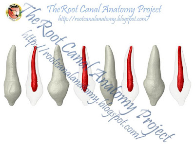 The Root Canal Anatomy Project: Peg-Shaped Lateral Incisors (Conoid)