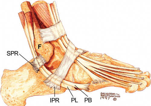 MRI Musculo-Skeletal Section: Peroneal tendon lesions.