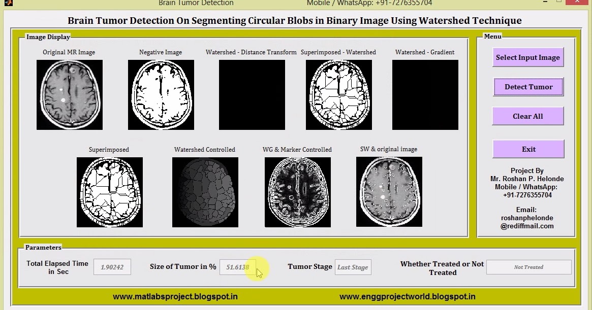 Brain Tumor Detection Using Watershed Technique Matlab Project Code ~ Low Price Projects