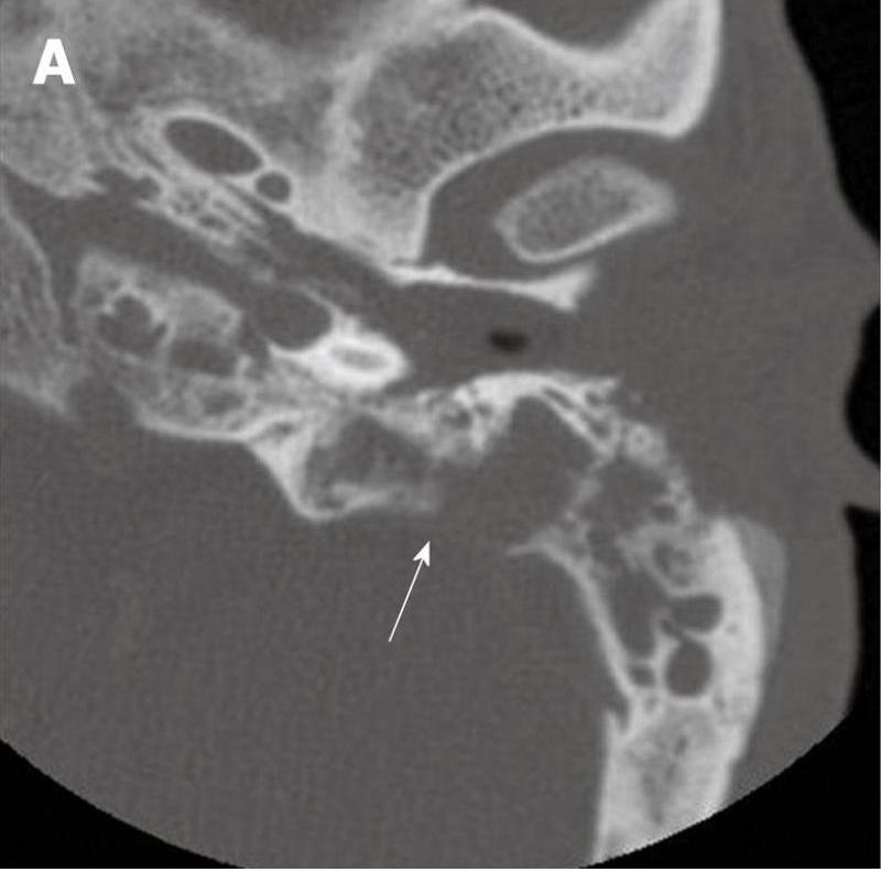 ABC Radiology Blog: Bezold Abscess
