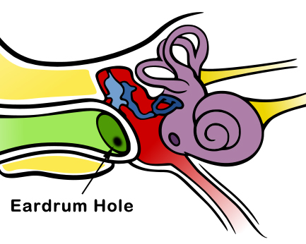How is a Hole in the Eardrum Repaired? | Fauquier ENT Blog