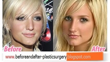 Ashlee Simpson before and after surgery | Before and After Plastic ...