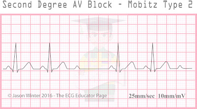 ECG Educator Blog : Heart Blocks
