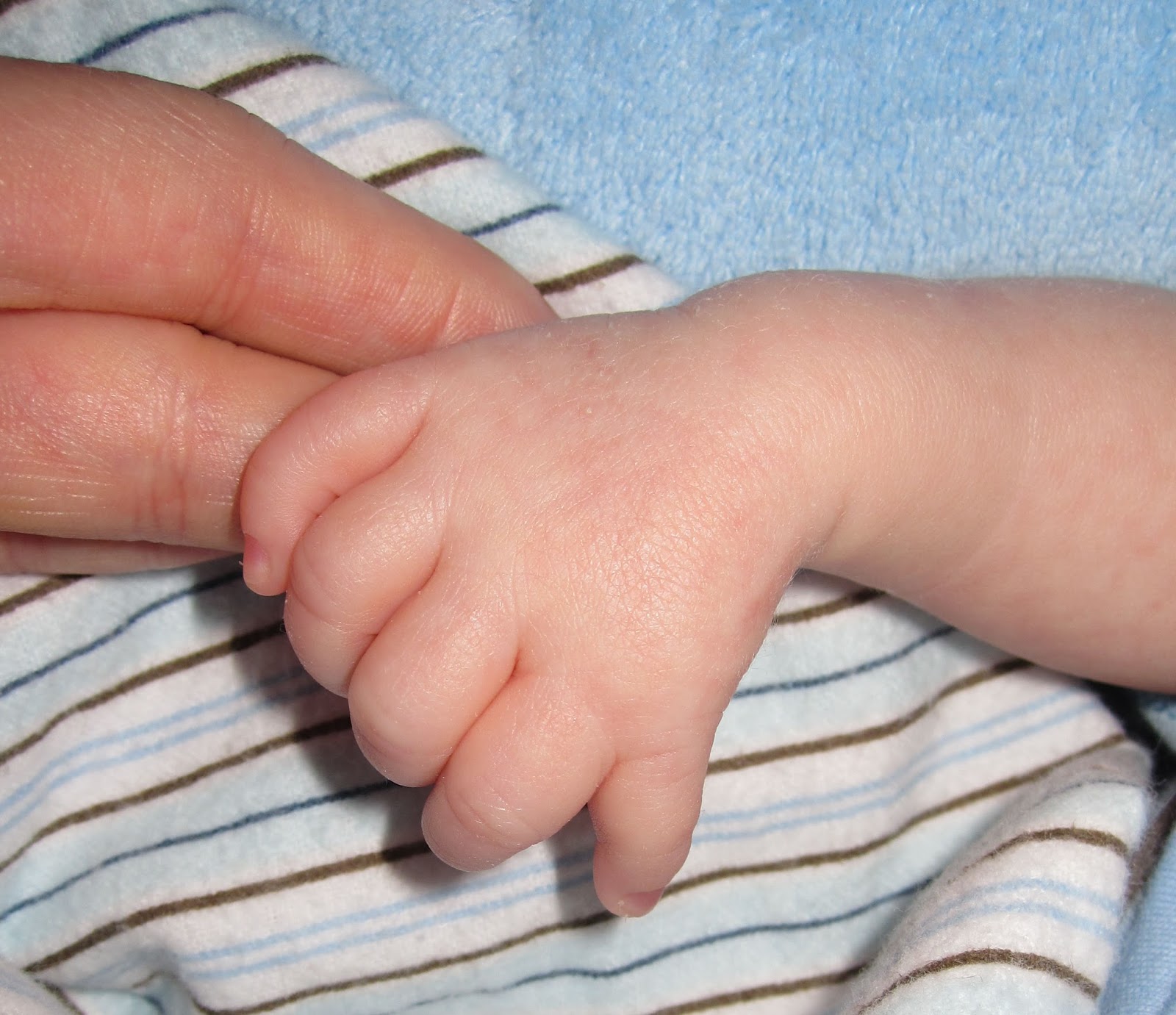 Not the Typical Thumb and Wrist | Congenital Hand and Arm Differences ...