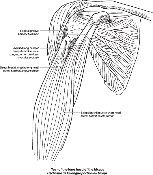 Shoulder and Elbow Surgery: Biceps Tendon Tear at the Shoulder ...