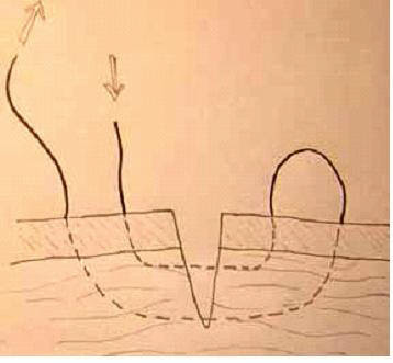 Enfermer@ en Urgencias y UCI : Técnica IX: Suturas en Urgencias. Tipos ...