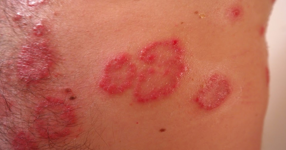 Psoriasis Digest: The Five Most Common Types of Psoriasis