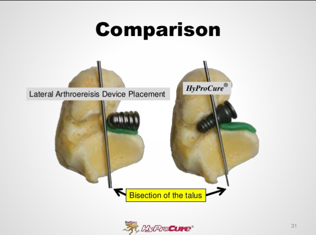 Welcome to My Hyprocure Procedure Recovery / Testimonial Blog!