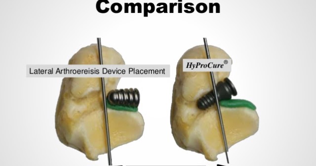 Welcome to My Hyprocure Procedure Recovery / Testimonial Blog!