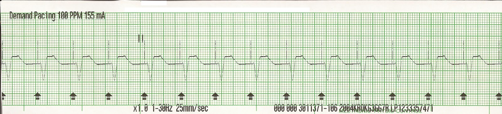 ECG Rhythm Strip Quiz 85: Electrical interventions