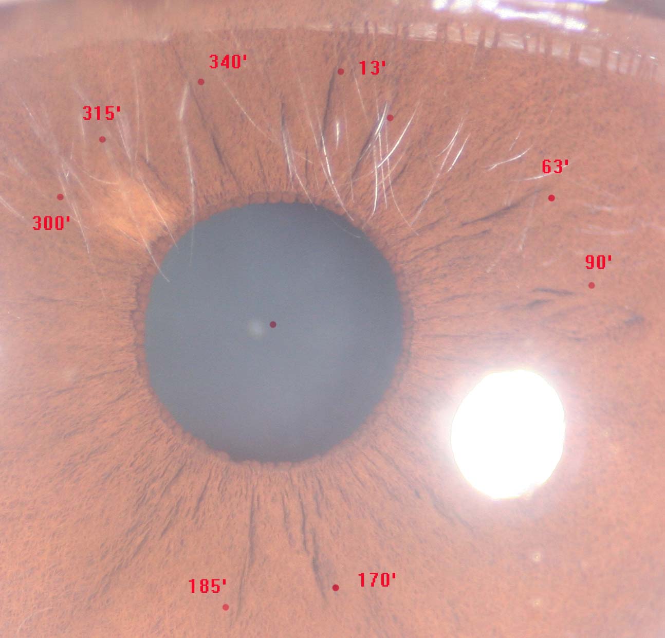 Modern & Multidimensional Iridology: Radii Solaris / Radial Furrows - (slc)