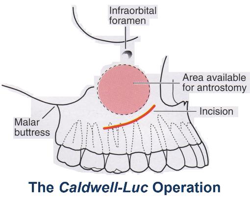 WizDent: Caldwell-Luc operation