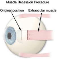 Understanding Williams Syndrome: Eyes