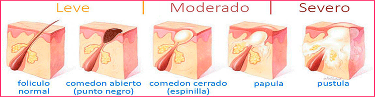 Acne With Pus | After Pregnant