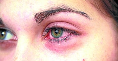 Olho inchado: retenção de líquidos e inflamações estão entre as causas ...