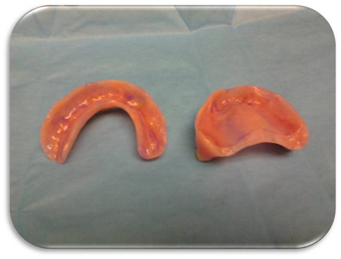 Rebase de Prótesis Total Superior e Inferior