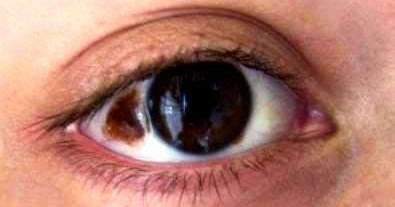 Nevus of Ota | the dynamic natural skin care