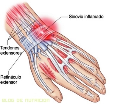Enfermedades profesionales, un enemigo silencioso.: Tendinosis y ...