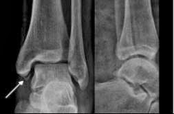 ZONA RADIOLOGY: Teknik Pemeriksaan Radiografi Ankle Joint