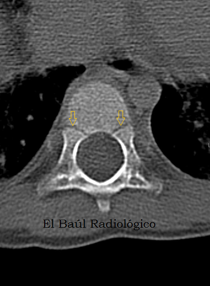 El Baúl Radiológico: SINCONDROSIS NEUROCENTRAL DE LOS CUERPOS ...