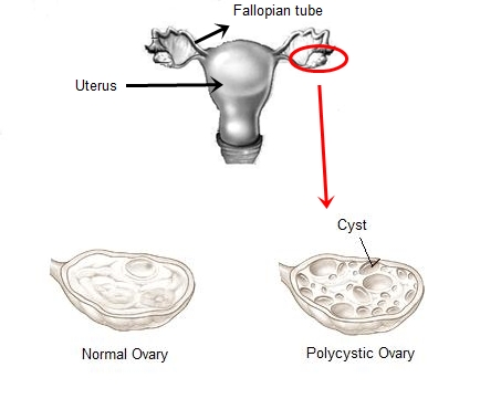 Always Perfect Life: CYST..(Sista Ovari)