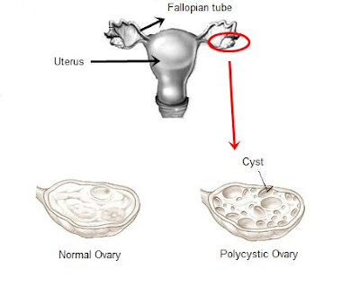 Always Perfect Life: CYST..(Sista Ovari)