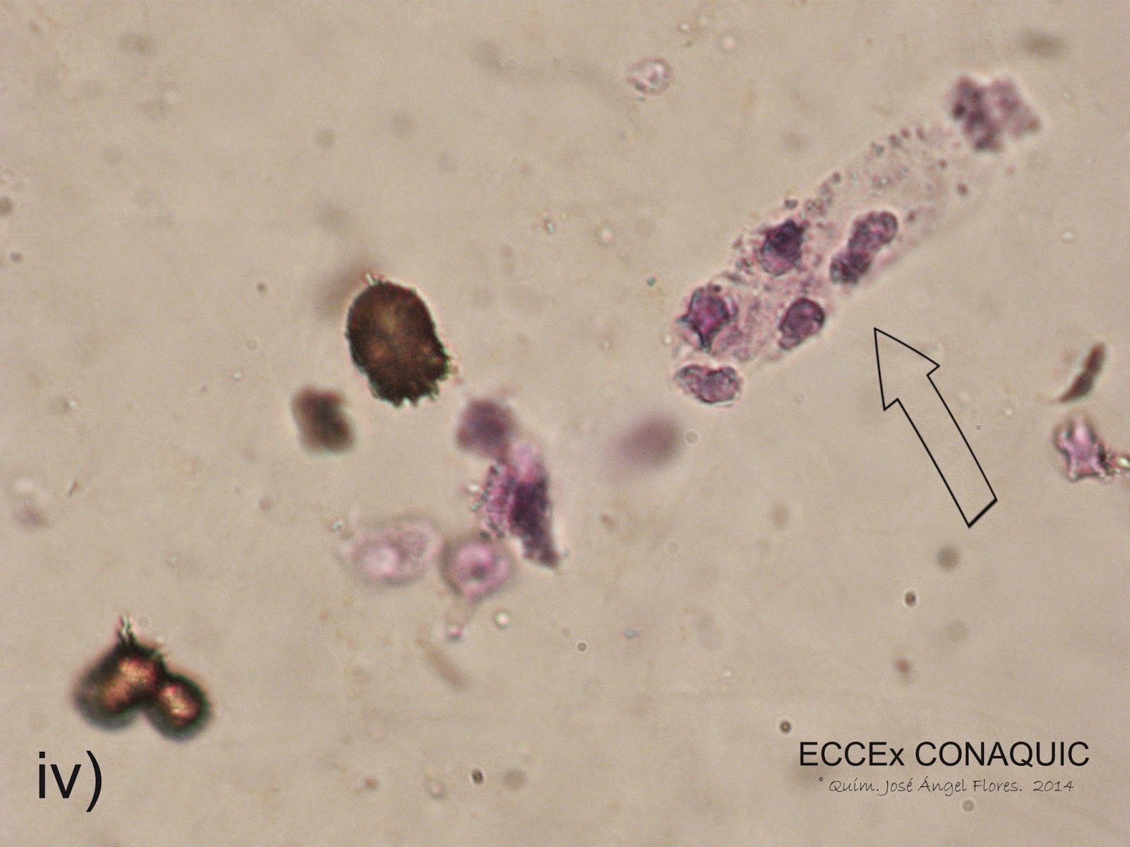 Caso UR-abril-14 (Enfoque: cristaluria)