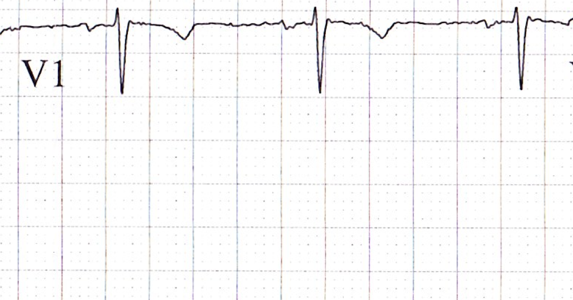 Doc Cottle's Desk: How to cure incomplete RBBB.
