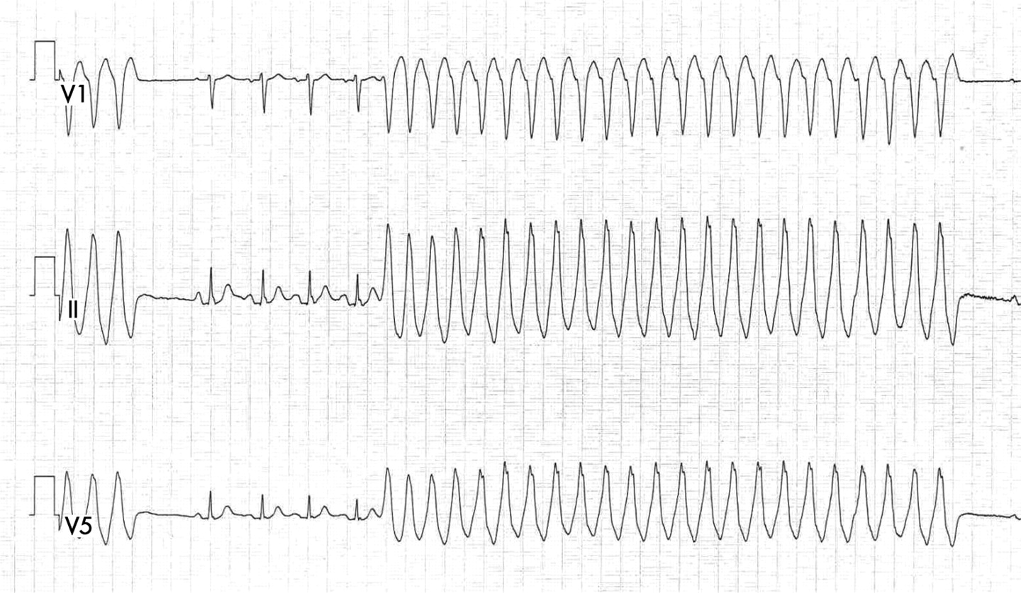 FIREFIGHTER/PARAMEDIC STORIES: Heart Rhythms Part 4: Ventricular Rhythms