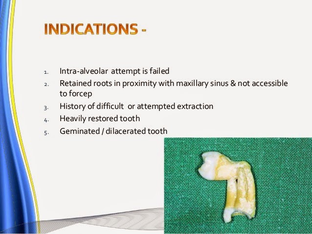 ODONTOS ACADEMY FOR CLINICAL DENTAL STUDIES: How to Extract a TOOTH ...
