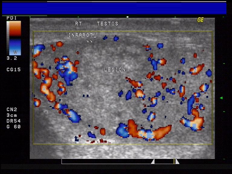 SONO DIGEST: SEGMENTAL TESTICULAR INFARCT
