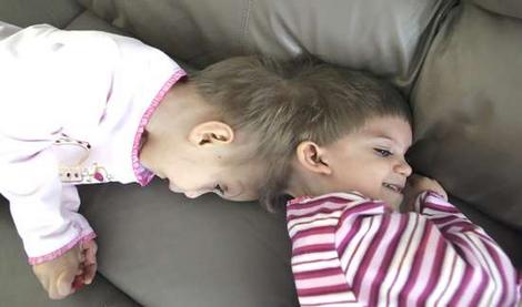 Normal Two Headed Twins ~ brainexplor