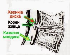 Diskus hernia: Diskus hernija, prolaps međupršljenskog diska