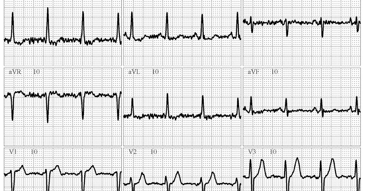 Sobrecarga De Ventrículo Esquerdo - RETOEDU