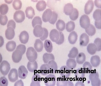 wabah penyakit malaria di Indonesia