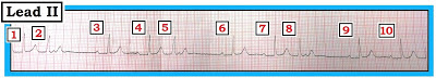 ECG Interpretation: ECG Blog #69 (Laddergrams – Group Beating)