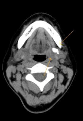 Sialolithiasis-CT - Sumer's Radiology Blog