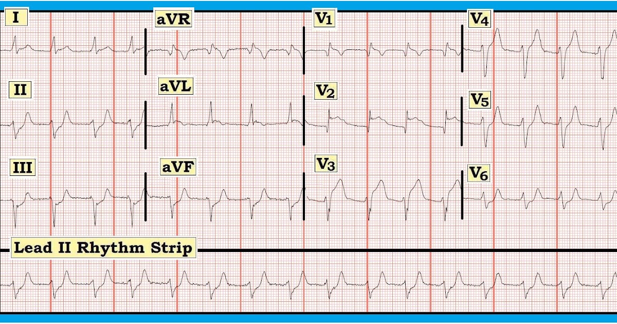 ECG Interpretation: ECG Interpretation Review #49 (Chest Pain - STEMI ...