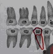 practical orthodontics: Bracket repositioning