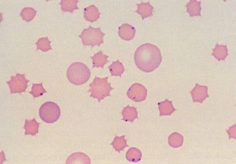 FROTIS SANGUÍNEO: La anaplasmosis enfermedad infecciosa.
