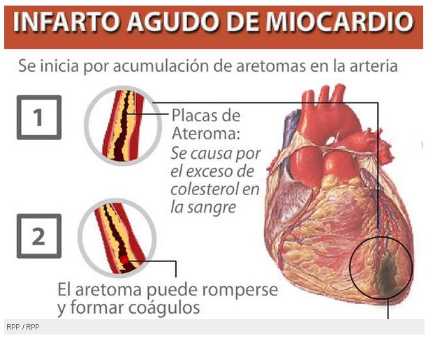 Entrenamiento Capacitación Medica Prehospitalaria SÍntomas De Infarto