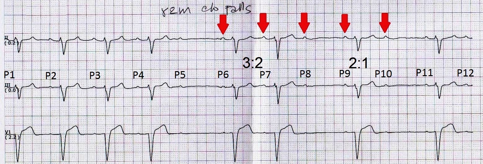 ECG Channel: Atrioventricular Block
