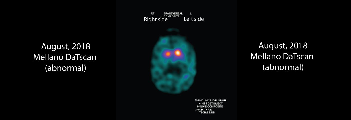 Our Parkinson's Place: My DaTscan Results Made My PD Diagnosis ‘Real’